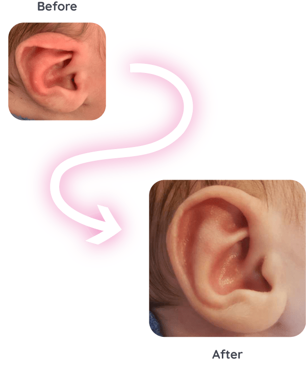 Ear Deformities - 1 in 3 infants are born with an ear deformity