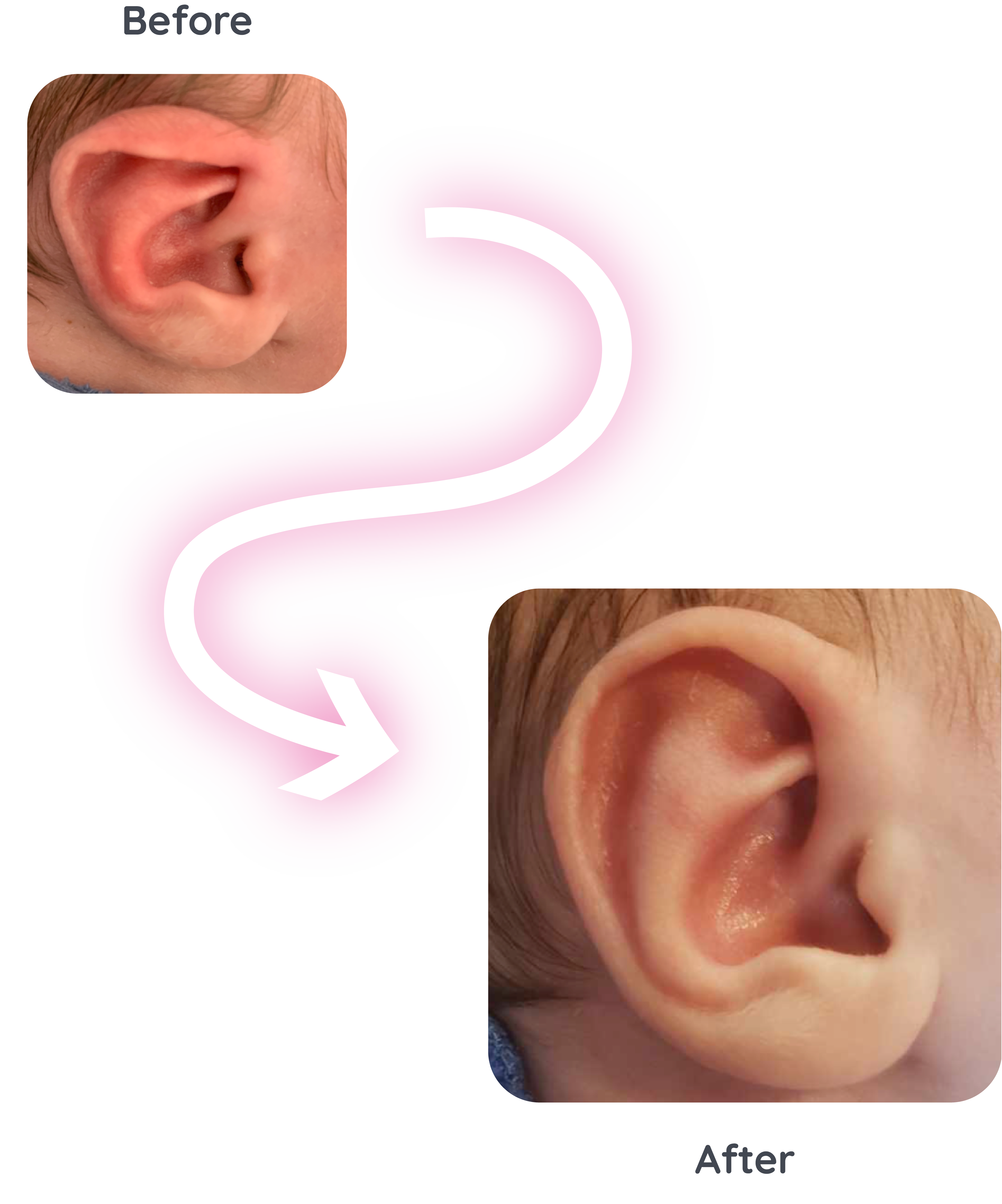 Ear Deformities - 1 in 3 infants are born with an ear deformity